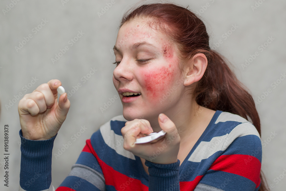 A young girl with an allergic rash on her face takes medicinal tablets ...