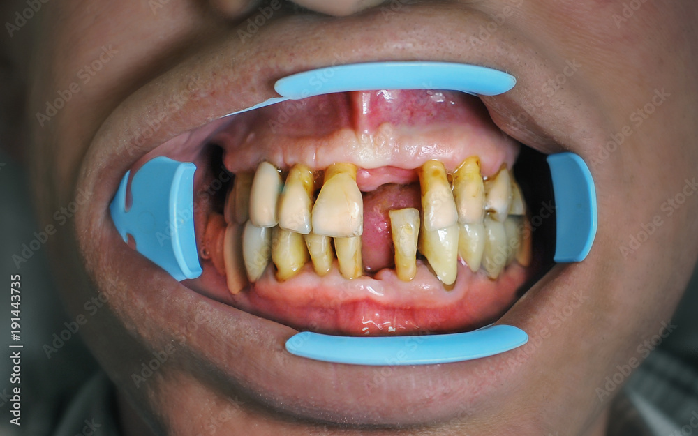 Abrasion Teeth