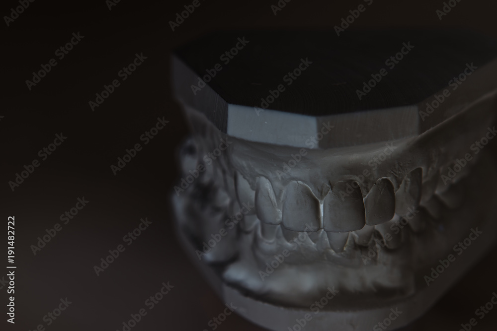 Gypsum model of human jaw on a white background. Stock Photo | Adobe Stock