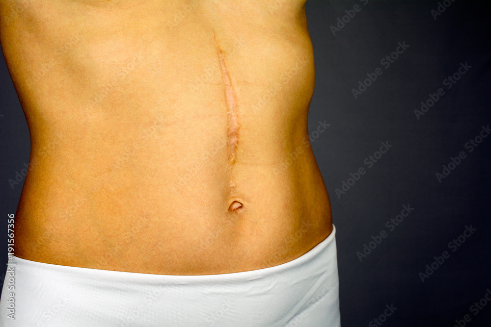 scars removal concept, large scar after surgery on the abdomen young ...