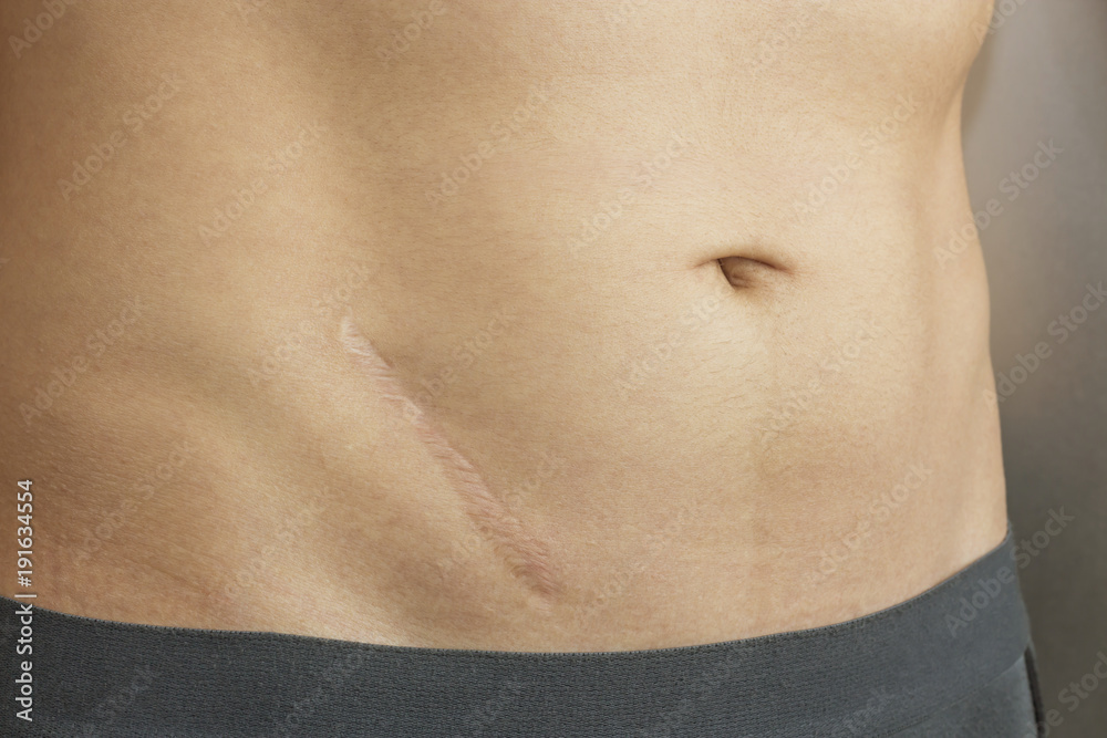 Appendicitis Scar Removal