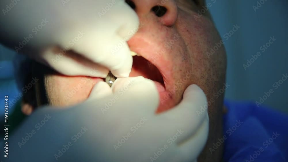 The mouth implants the tooth . Dental implant procedure . How do dental ...