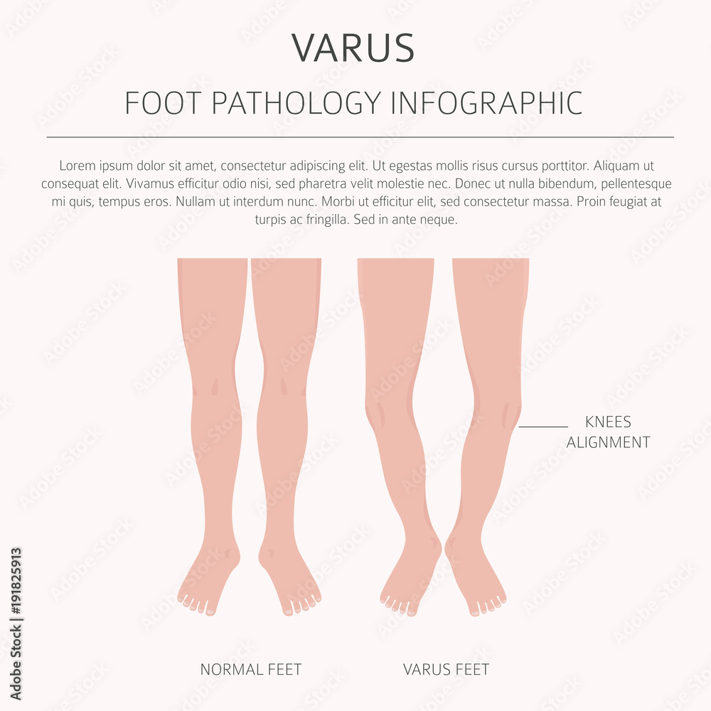 Foot deformation as medical desease infographic. Valgus and varus ...
