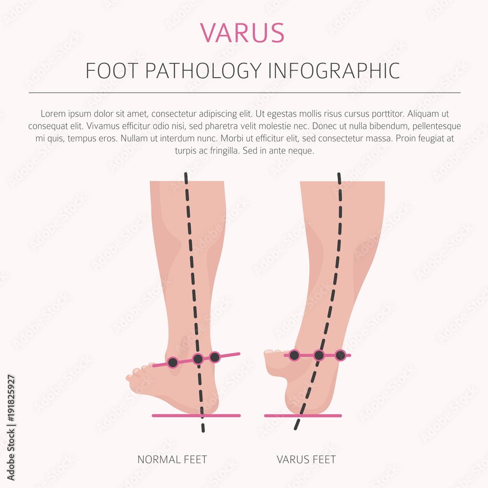 Foot deformation as medical desease infographic. Valgus and varus ...