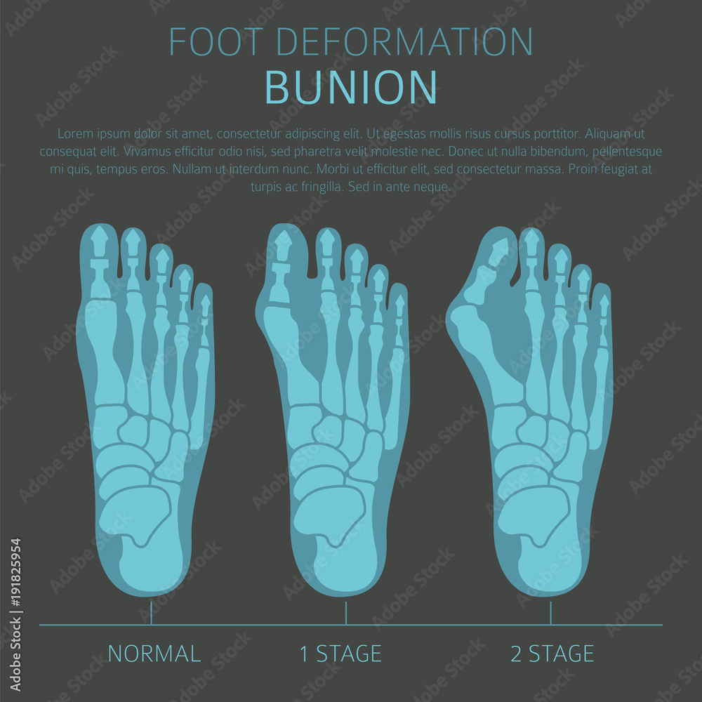 Foot deformation as medical desease infographic. Causes of bunion Stock ...