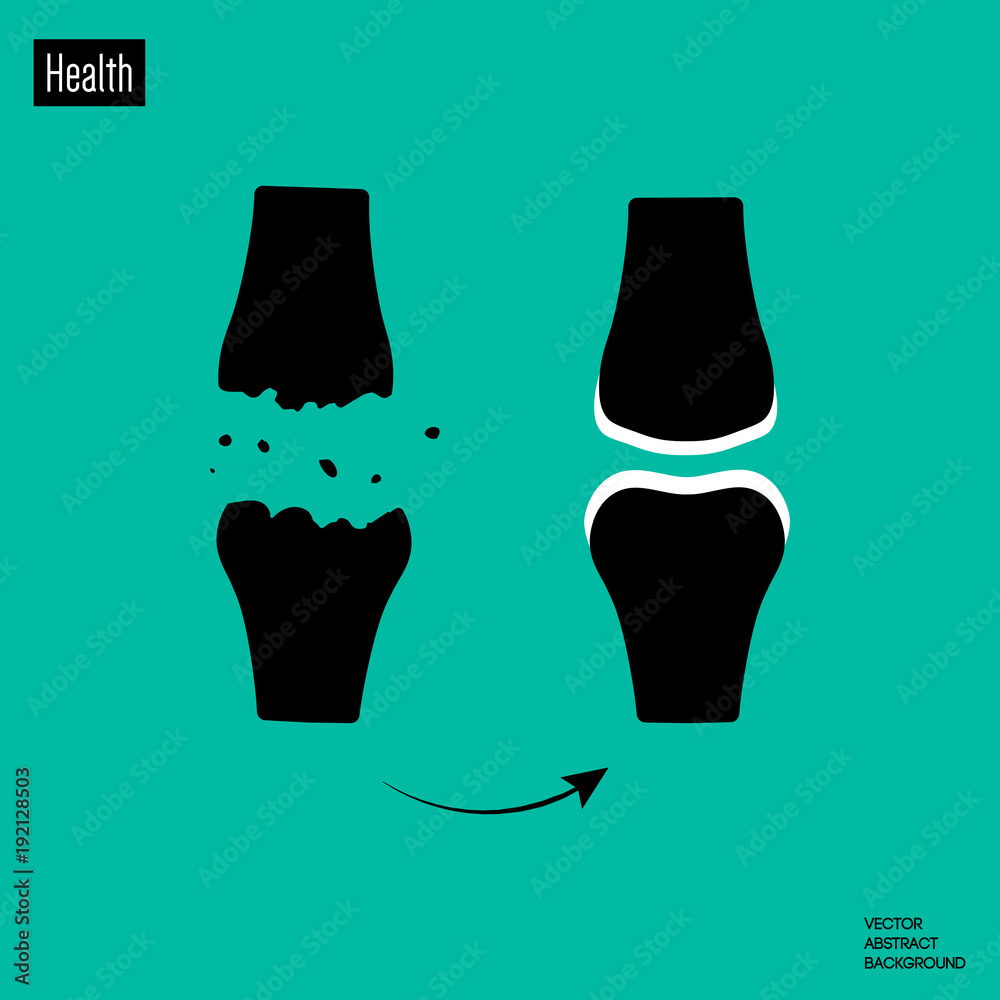 Fracture of the bone. Disease of the joints. Destruction of human bone ...