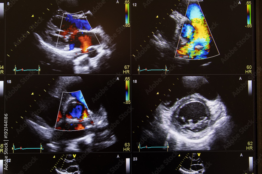 Heart ultrasound image on a computer screen. Stock Photo | Adobe Stock