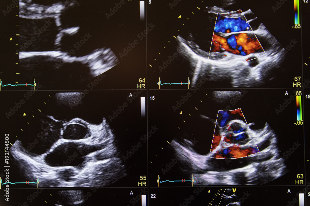 Heart ultrasound image on a computer screen. Stock Photo | Adobe Stock