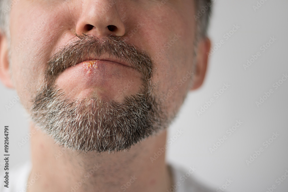 Medicine, Illness, Herpes, Zoster, Man, Beard, Healthy Stock Photo ...