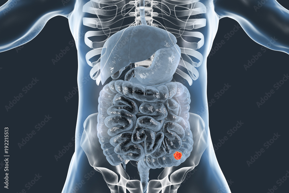 Colorectal cancer awareness medical concept, 3D illustration showing ...