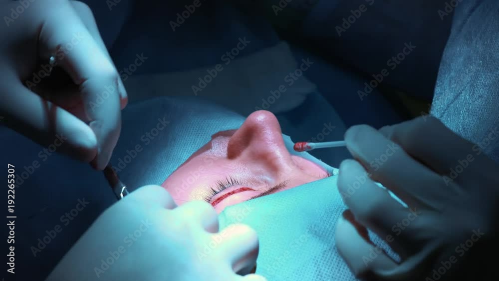 The surgeon is performing an operation on the eyes, close-up ...