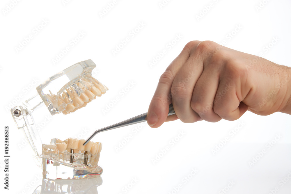 Dental technician placing the fixed partial denture, dental bridge on ...