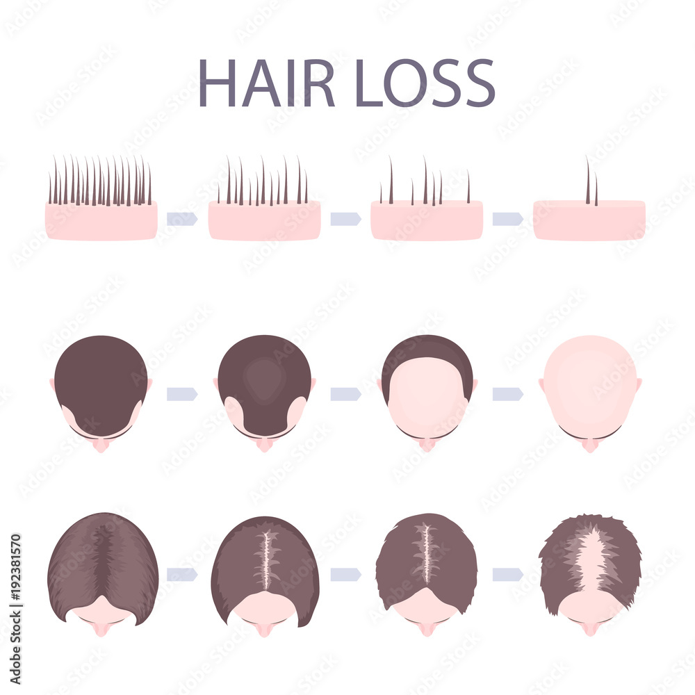 Male and female pattern hair loss set. Stages of baldness in men and ...