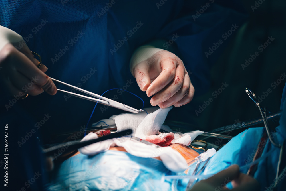 Needle holder or a needle driver in doctor's hand, a surgical ...