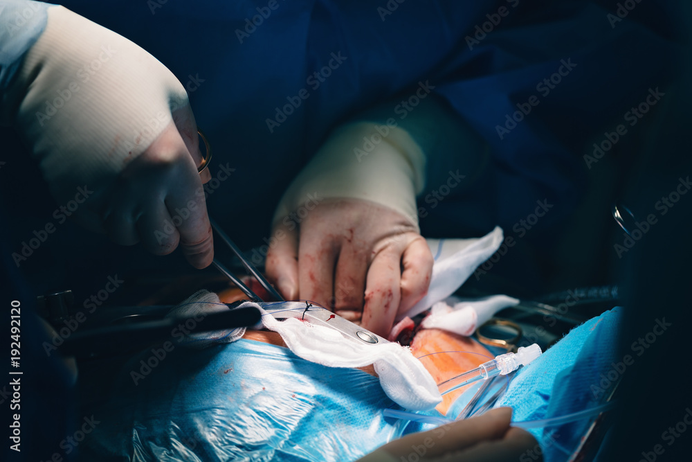 Needle holder or a needle driver in doctor's hand, a surgical ...