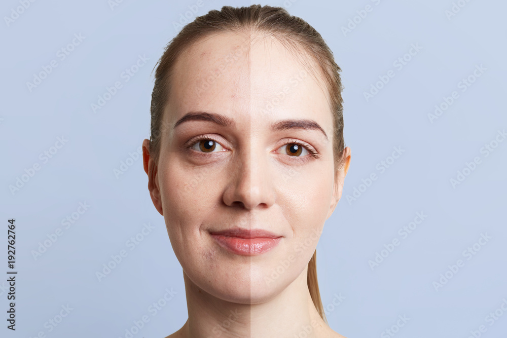 Close up portrait of woman`s face divided into two parts: healthy pure ...