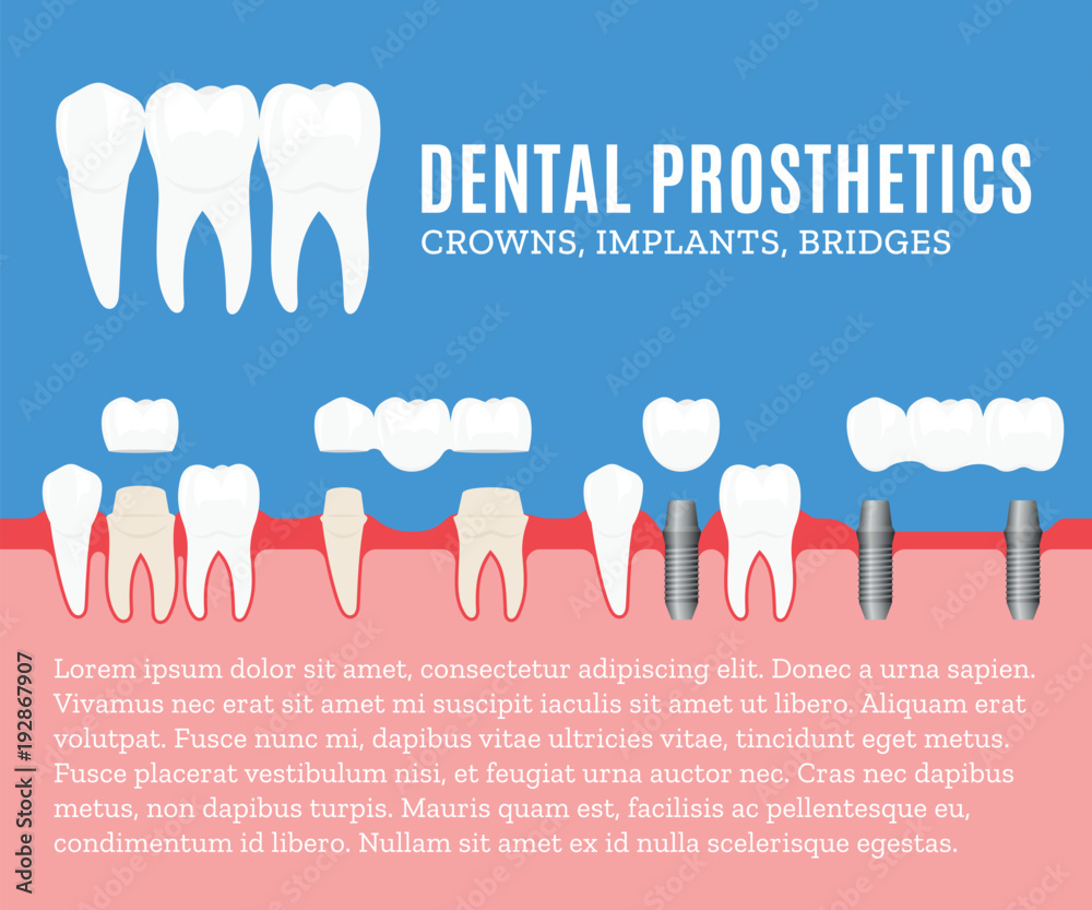 Dental prosthetics illustration Stock Vector | Adobe Stock
