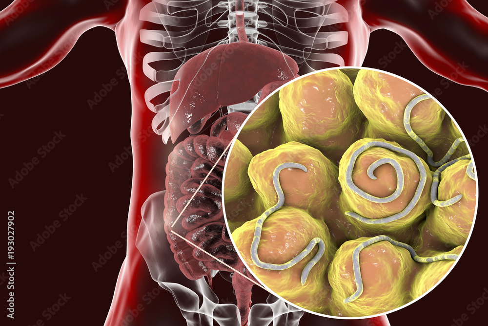 Helminths nematodes Enterobius in the gut. Threadworm which causes ...