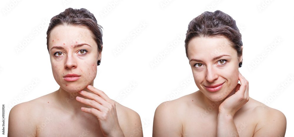 Young woman looking concerned about face skin problems and smiling ...
