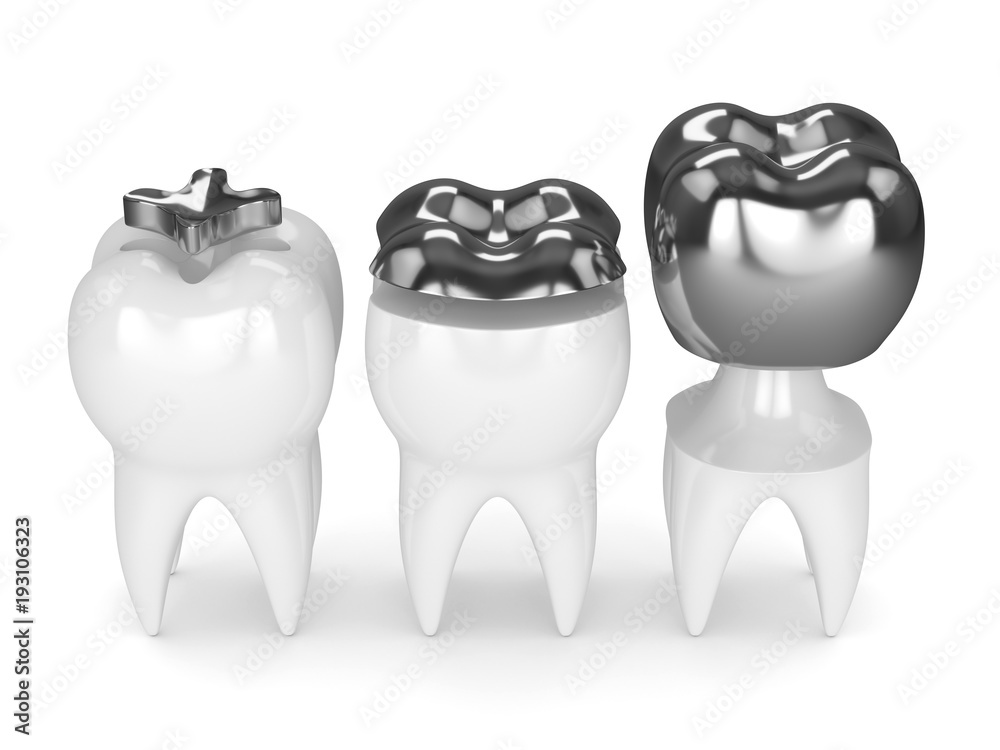 3d render of teeth with different types of dental amalgam filling Stock ...