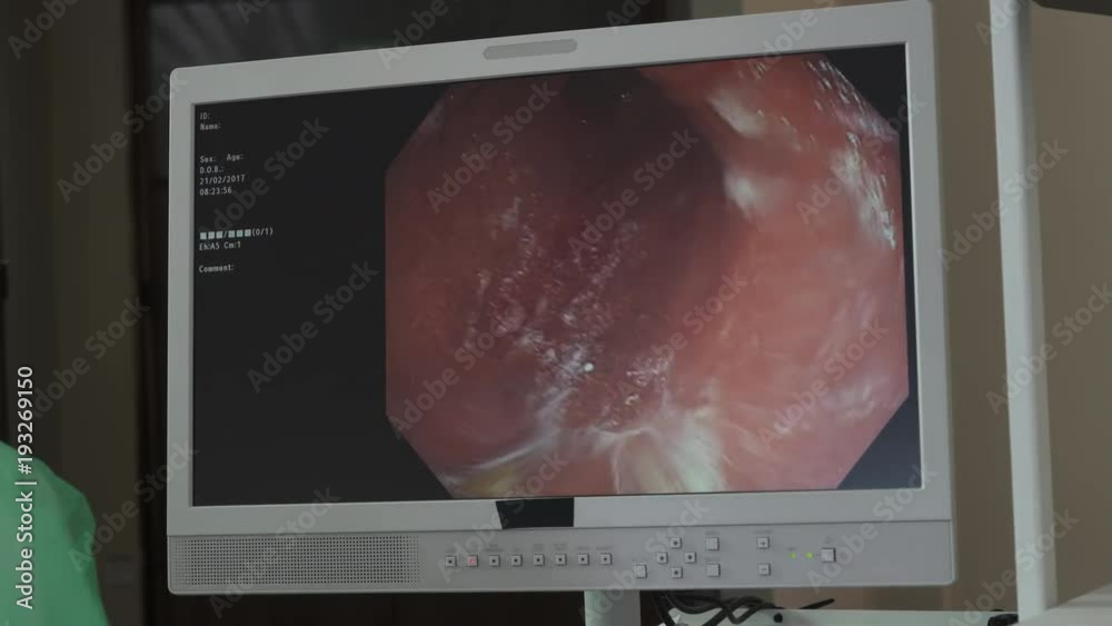 Vidéo Stock Computer screen during gastroscopy review close up, inside ...