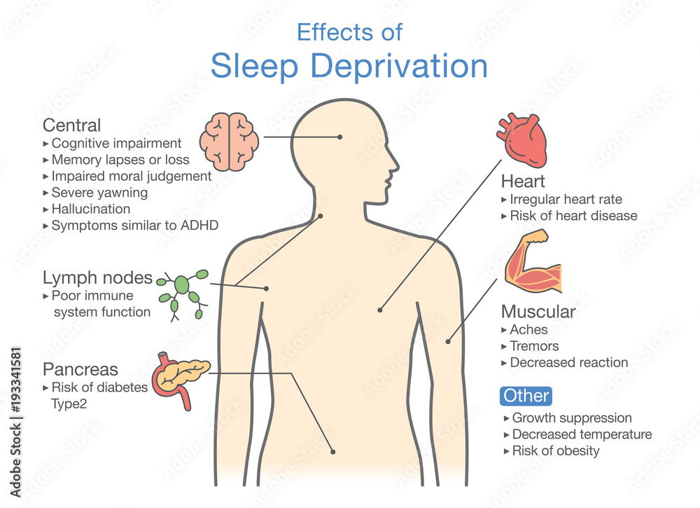Diagram of Effects of Sleep deprivation. Illustration about disease ...
