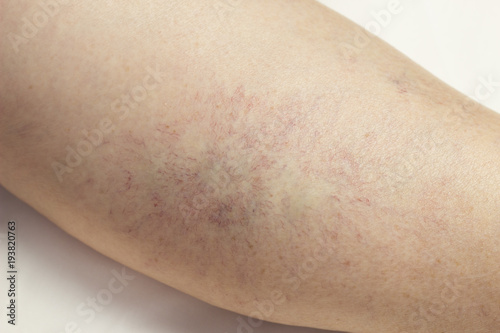 Skin disease on the body, viral skin disease Measles rash with ...