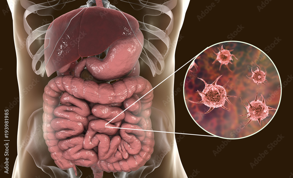 Parasitic infection of intestine, 3D illustration showing close-up view ...