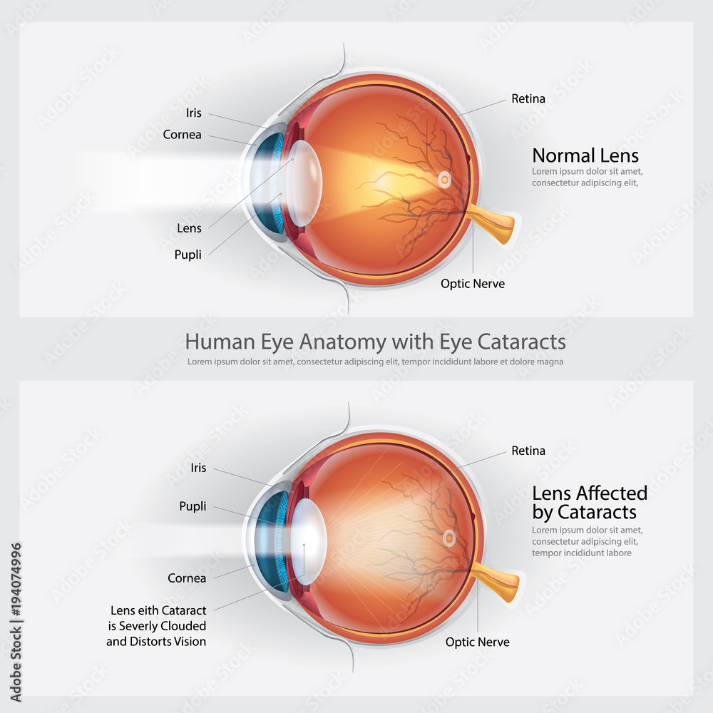 Cataracts Vision Disorder and Normal Eye Vision Anatomy Vector ...