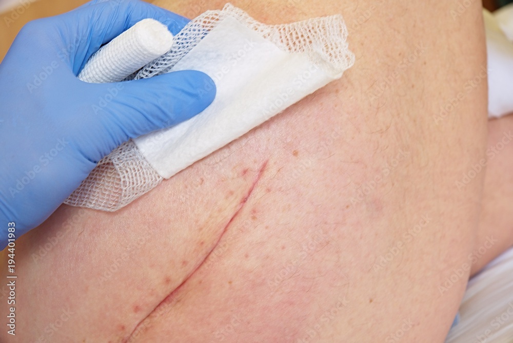 Patient with fresh long scar on hip lay in hospital bad. Nurse hand ...