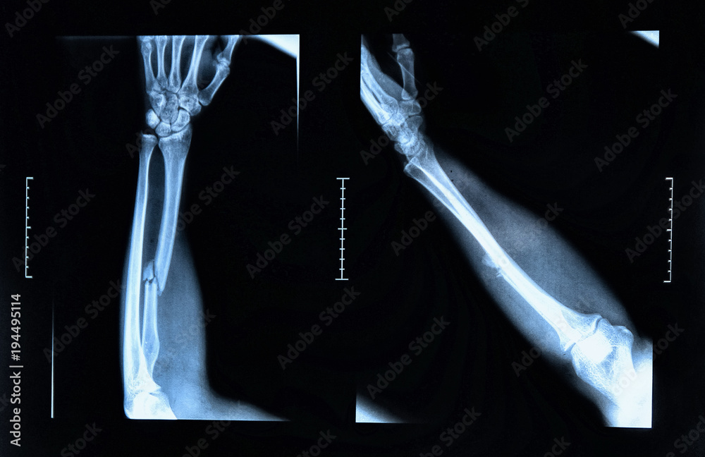 Arm fracture seen on x-ray Stock Photo | Adobe Stock