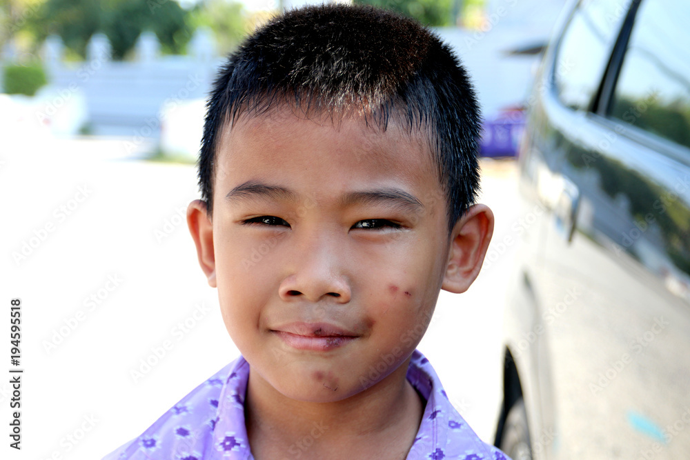 Foto Stock asian boy smile with wound on his face and lip are crack ...
