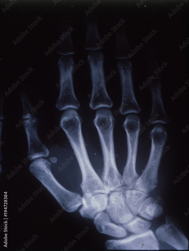 Röntgenbild der Hand Stock-Foto | Adobe Stock