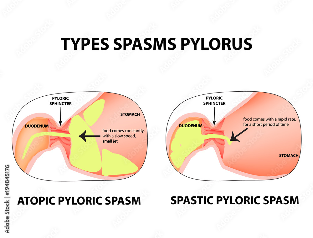 Stomach Pylorus