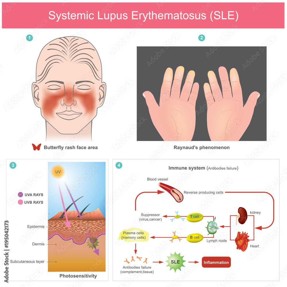 Systemic Lupus Erythematosus (SLE). The patients skin inflammation from ...