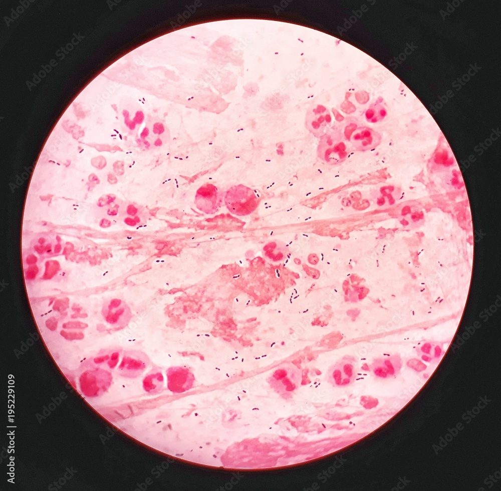 Smear of Gram's stained from sputum specimen with gram positive cocci ...