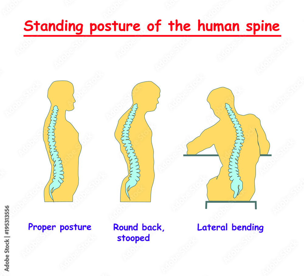 Standing posture of the human spine. Defects of the human spine ...
