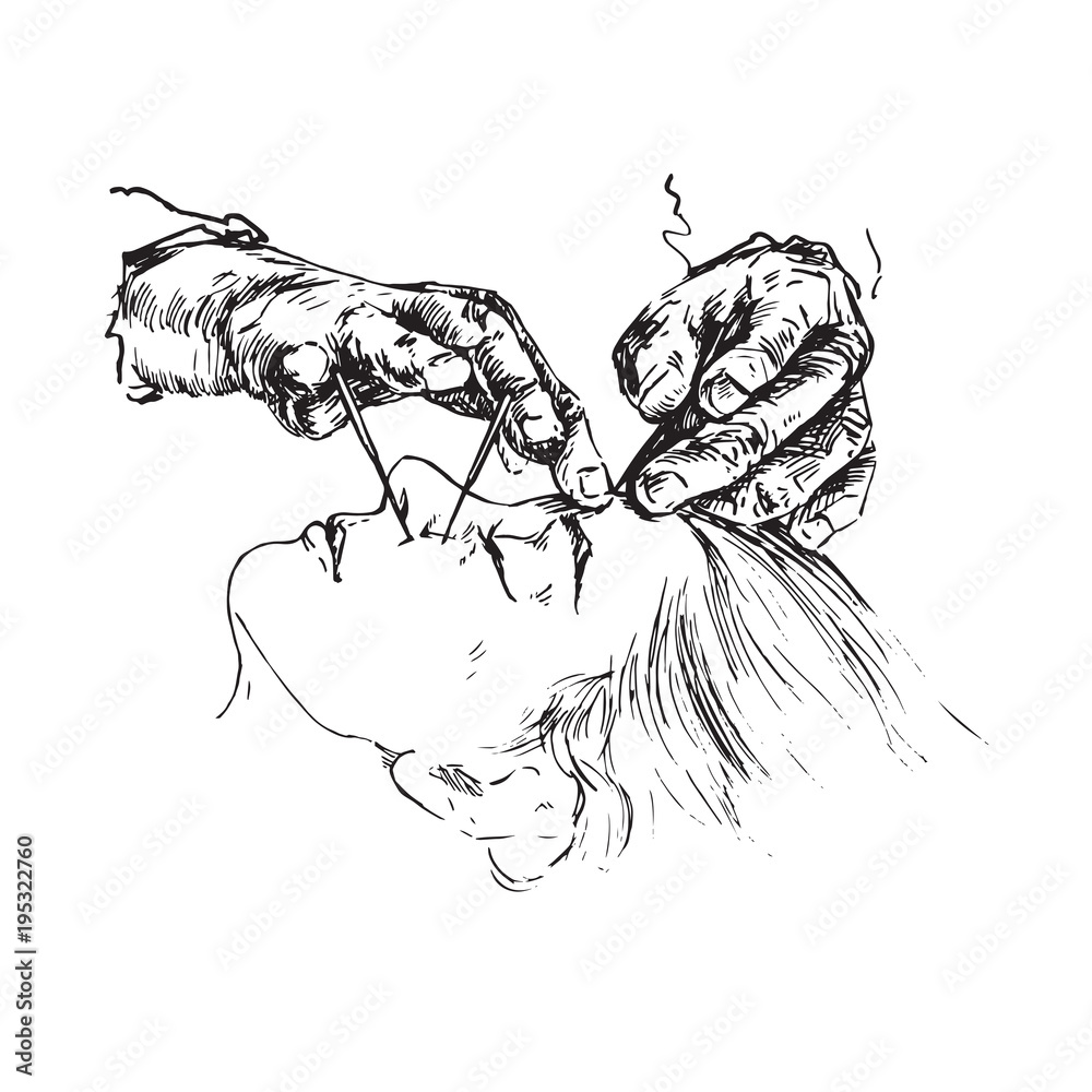 Doctor insert acupuncture needles in beautiful woman face, hand drawn ...