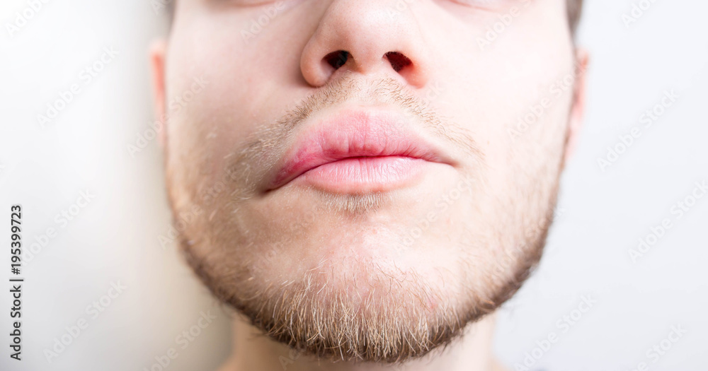 Quincke's edema, allergic reaction of angioedema. stroke. Stock Photo ...