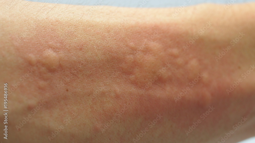 Macro image of symptoms of itchy urticaria or rash Stock Photo | Adobe ...