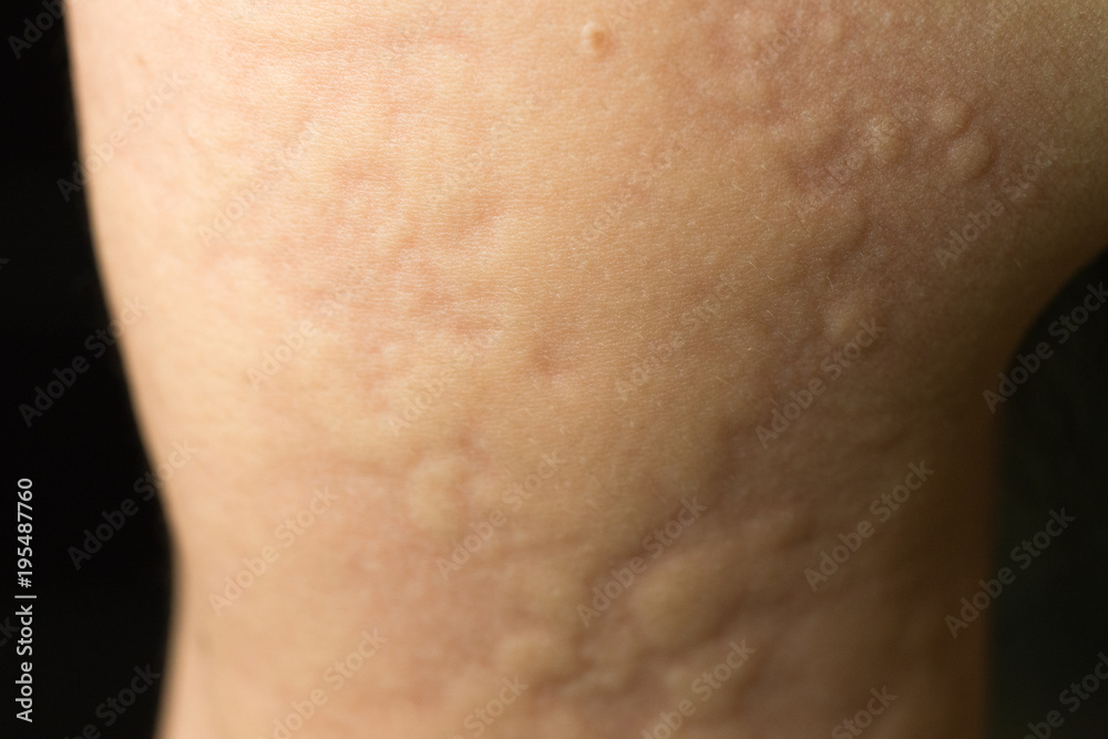 Macro image of symptoms of itchy urticaria or rash Stock Photo | Adobe ...