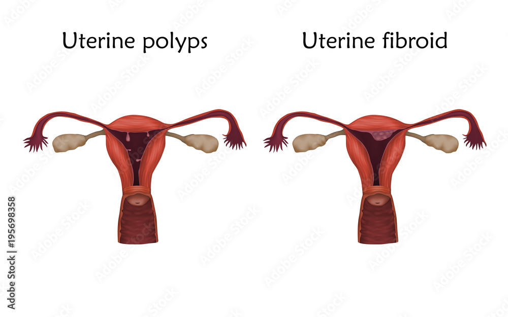 Uterine polyps and uterine fibroid. Human realistic uterus. Anatomy ...