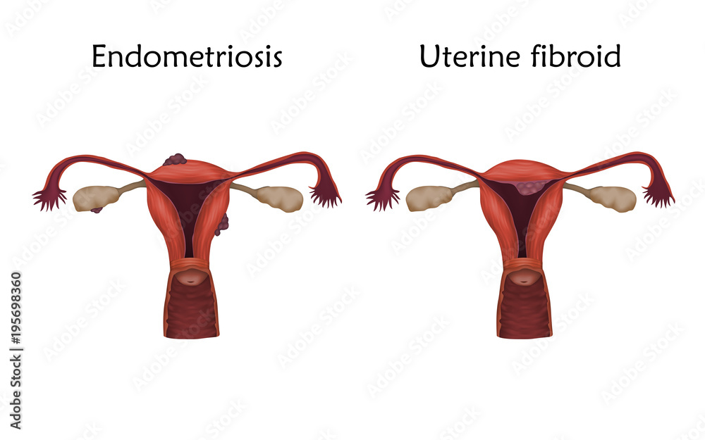 Endometriosis and uterine fibroid. Human realistic uterus. Anatomy ...