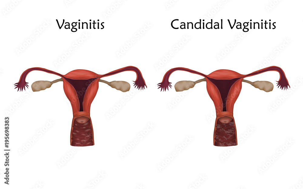 Vaginitis and candidal vaginitis. Human realistic uterus. Anatomy ...