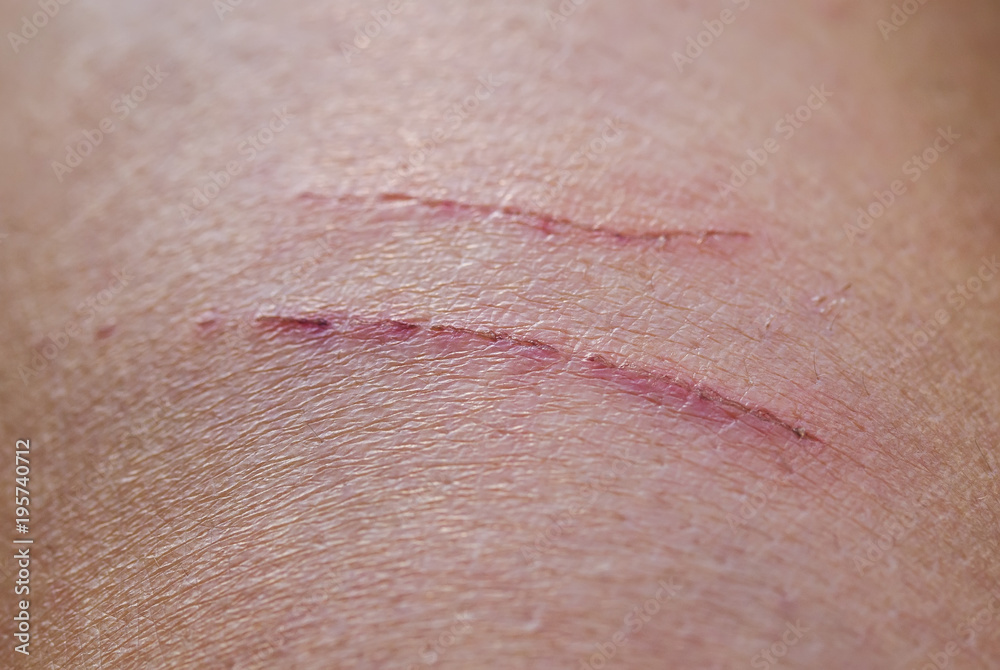 two shallow aching sore inflamed scratches on human skin Stock Photo ...