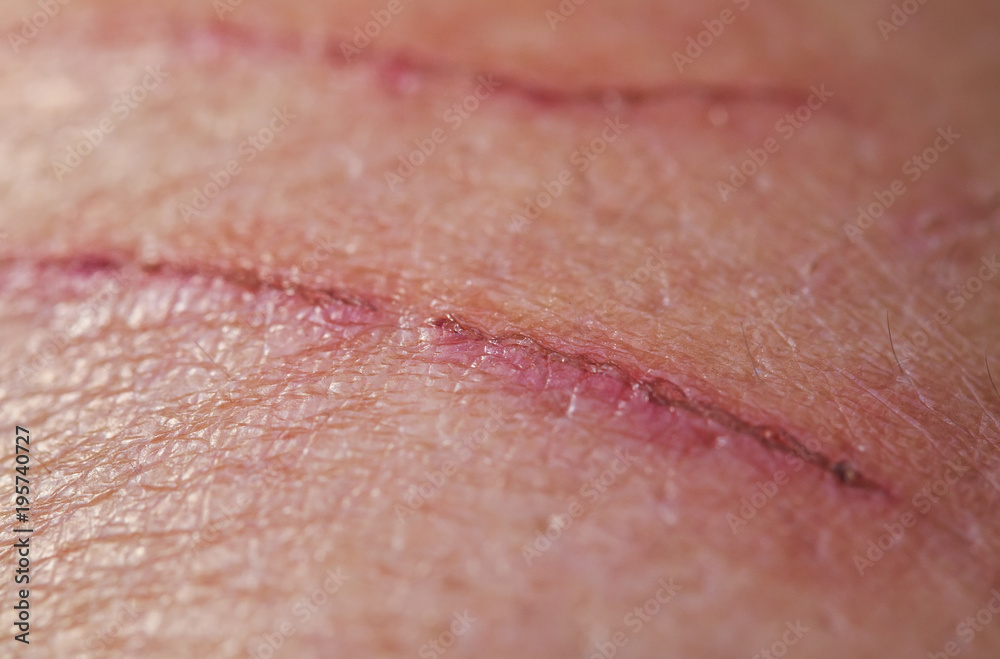 sore inflamed scratch on human skin Stock Photo | Adobe Stock
