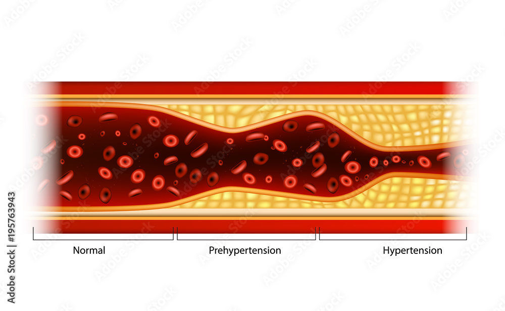 Hypertension and Prehypertension. Plaque in blood vessels Stock Vector ...