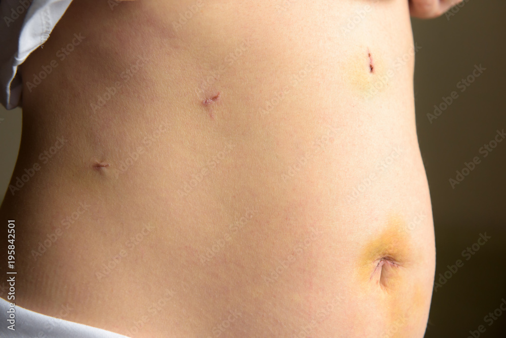 Woman s Belly With Medical Stitches After Surgery By Laparoscopy Stock woman-s-belly-with-medical-stitches-after-surgery-by-laparoscopy-stock