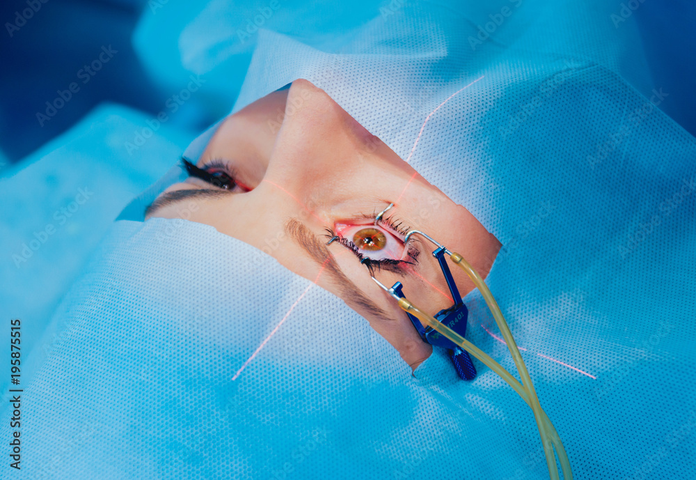 Laser vision correction. A patient and team of surgeons in the ...