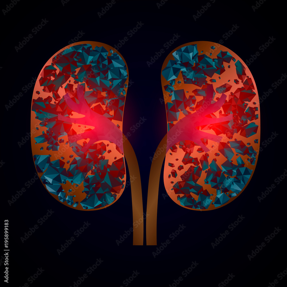 Nephrolithiasis kidney stones disease. Vector medical illustration ...